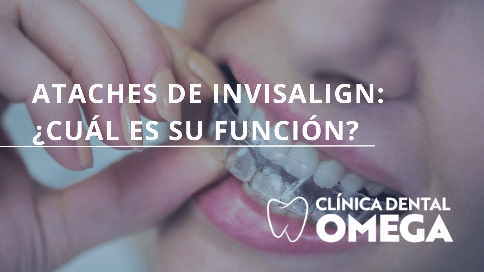 Ataches de invisalign, ¿cuál es su función?